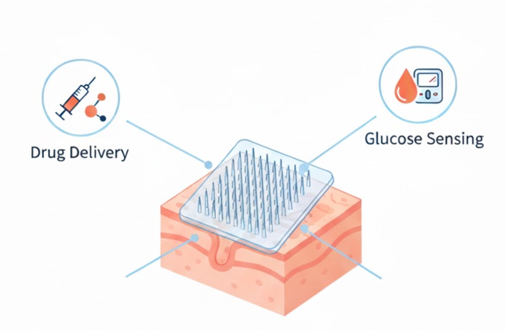 Glucose-Responsive Microneedle Patch - Invitrovo